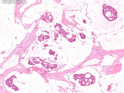 Mucinous Carcinoma Of Breast