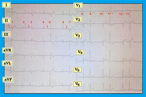 Ecg Interpretation Ecg Blog 140 Pvc Atrial Bigeminy Pac Lahb