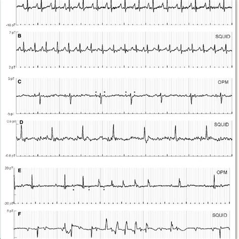 Comparison Of Optically Pumped Magnetometer Opm And Superconducting Download Scientific