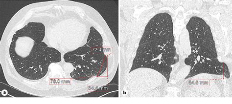 Figure 1 From Natural History Of Lung Hernias Semantic Scholar