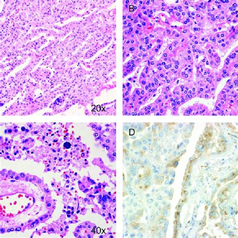 Overview Of Choroid Plexus Tumors Download Table