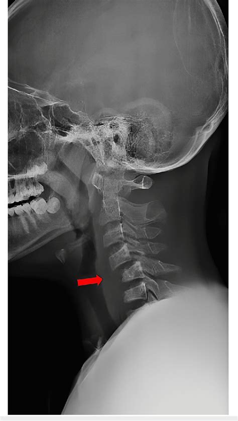 Figure 1 From Bilateral Cervical Facet Dislocation Due To Catastrophic Shallow Water Diving A