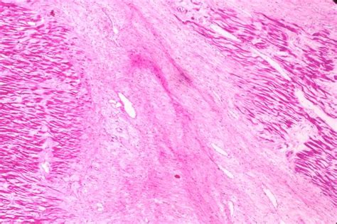 Unstable Angina Non ST Elevation Myocardial Infarction And Diabetes Mellitus Wikidoc