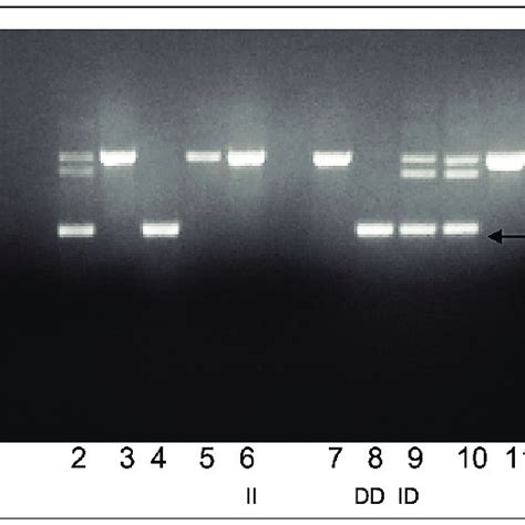 Ace Gene Polymorphism Ii Polymorphism Is Shown At Lane 3 5 6 7 11