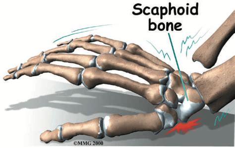 Scaphoid Edmonds Orthopedic Center