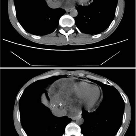 PDF Primary Pleomorphic Liposarcoma A Rare Mediastinal Tumor