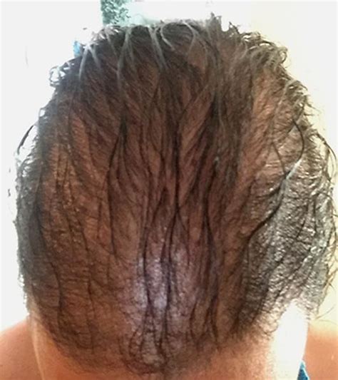 Diffuse Hair Loss On The Frontal Scalp And Vertex Of The Scalp With Download Scientific Diagram