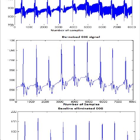Original Ecg Signal De Noised Ecg Signal And Baseline Wander Download Scientific Diagram
