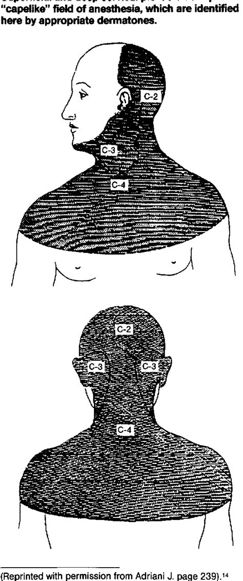 Figure 1 From Superficial And Deep Cervical Plexus Block Technical Considerations Semantic