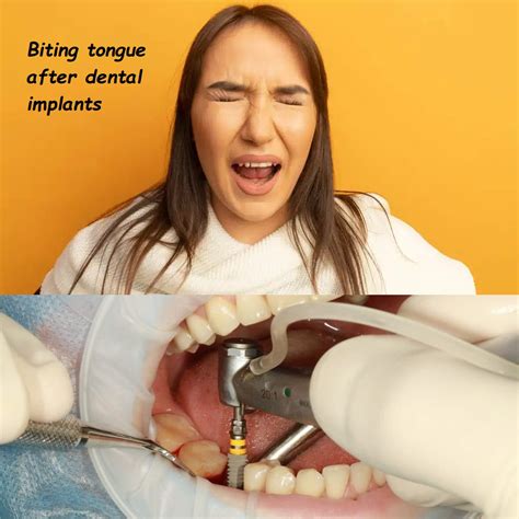 Biting Tongue After Dental Implants Dr Haroon Dental Specialist