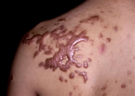 How To Treat Keloids