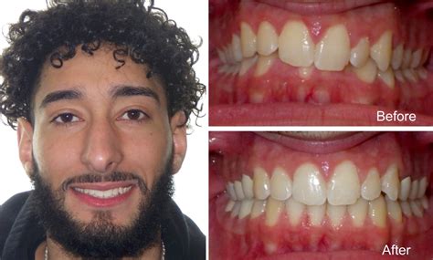 Male 21 Years Old With Overbite Before And After Invisalign Treatment
