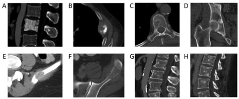 Incidence And Prevalence Of Bone Metastases In Different Solid Tumors