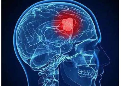 杨院长带你了解脑子里面长肿瘤有多严重 知乎