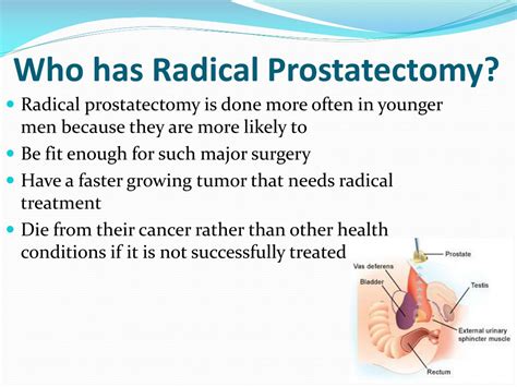 Ppt Radical Prostatectomy Surgery India Powerpoint Presentation Free Download Id1414612