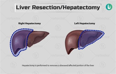Liver Resection Hepatectomy Procedure Purpose Results Cost Price
