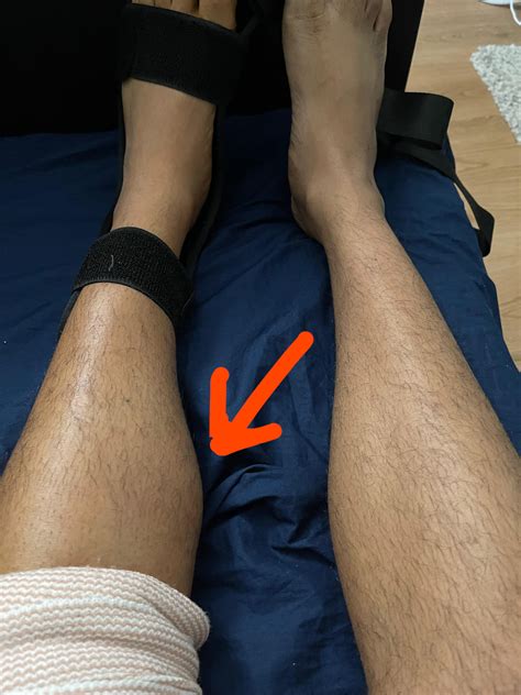 Day 3 Post Acl Surgery Distinct Swollen Calf Is Normal No Bruising Or