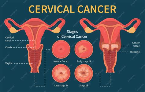 Cervical Cancer Infographic Illustration Premium Vector