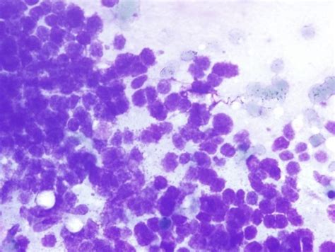 Bone Marrow Necrosis