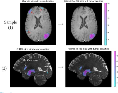 Figure 7 From Glioma Multimodal Mri Analysis System For Tumor Layered