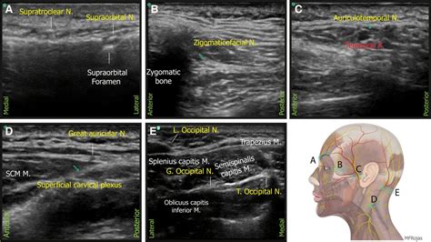 Influence Of Levobupivacaine Regional Scalp Block On Hemodyn Anesthesia Analgesia