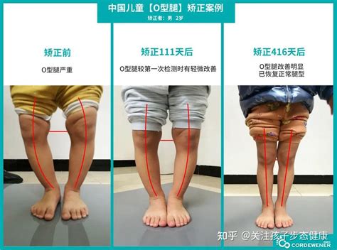 科案例｜儿童步态矫正展示－ O型腿 知乎