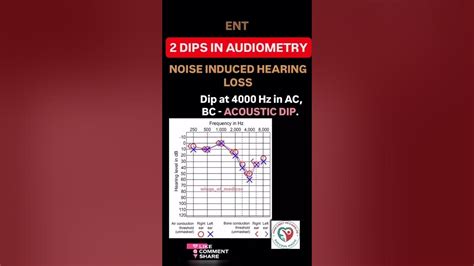 Ent Dip Of Audiometry Curves Of Audiogram Otosclerosis Noise Induced Hearing Loss Youtube