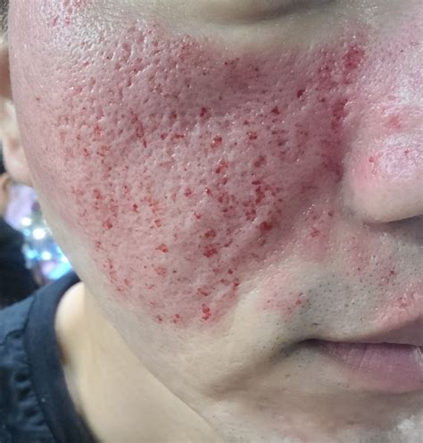 피코프락셀 고통 통증 부작용 10일간의 피부변화 내돈내산 네이버 블로그