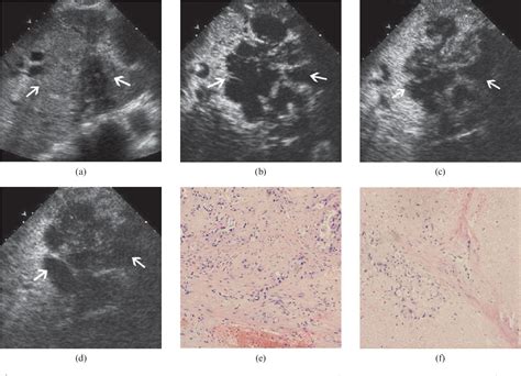 Figure 1 From Contrast Enhanced Ultrasound Of Intrahepatic Cholangiocarcinoma Correlation With