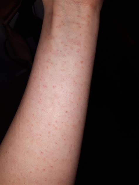 Ongoing Tiny Bumps Issue On Handswristsfeet Rdermatologyquestions