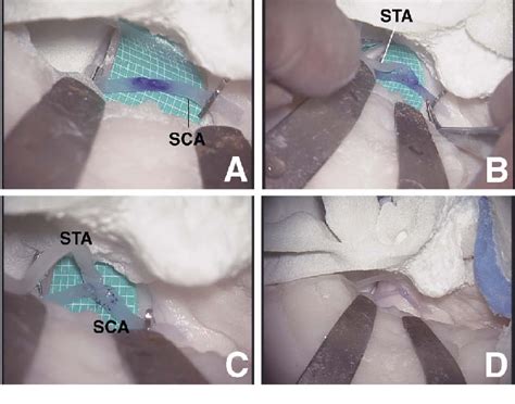 Simulated Procedures Of Superficial Temporal Artery Sta Superior