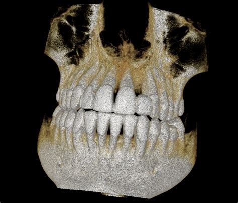 Vtkvolumemapper Rendered Graph Data Surface Has Black Spots · Issue 2661 · Kitwarevtk Js · Github