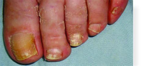 White Superficial Onychomycosis Download Scientific Diagram