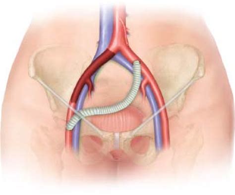 Iliofemoral Bypass Technique Bypass From Iliac Artery To Autologous