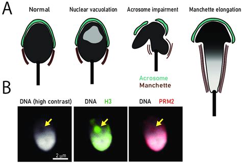 Schematic Illustration Of An Elongating Spermatid With Impaired Nuclear