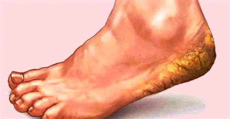 ქუსლების კანი ისეთივე ნაზი რომ იყოს როგორც ახალგაზრდობაში გამოიყენეთ ეს საშინაო საშუალებები