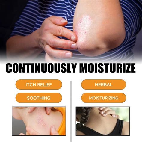 Seborrheic Dermatitis Spray Psoriasis Eczema Fungal Treatment Repair