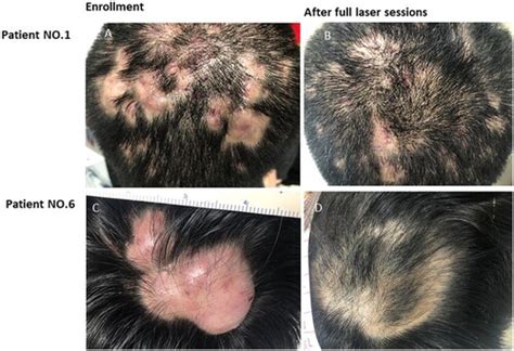 Scalp Cellulitis