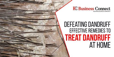 Defeating Dandruff Effective Remedies To Treat Dandruff