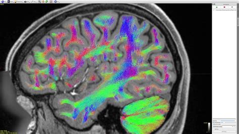 Multi Tissue Constrained Spherical Deconvolution On Hcp Data Youtube