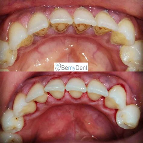 Почистване на зъбен камък Дентално Студио Bemydent