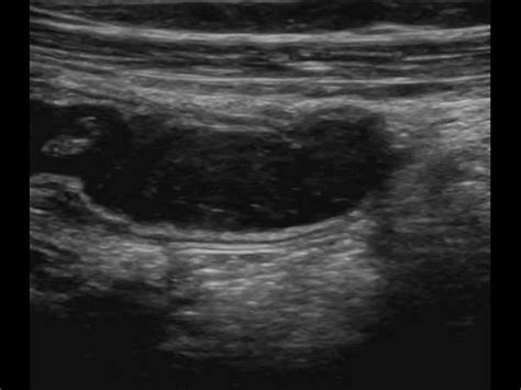 Abdomen And Retroperitoneum 1 5 Appendix Case 1 5 5 Mucocele Or Cystadenoma Of The Appendix