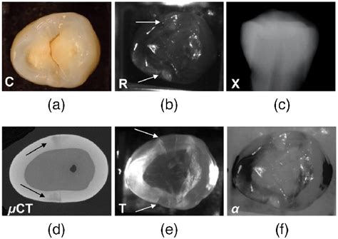 A Color B Swir Reflectance At 1600 Nm C Dental Radiographic