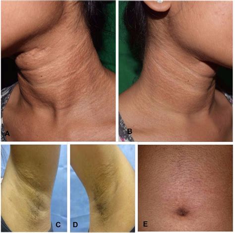 Dermoscopy Of Pseudoxanthoma Elasticum Bmj Case Reports