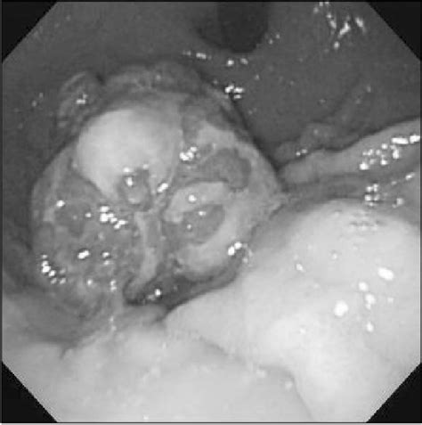 Endoscopic Finding Shows Multi Lobulated Polypoid Mass With Oozing At Download Scientific