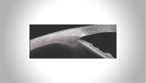 Accommodation Behavior And Ciliary Muscle Activity In Myopia Hector