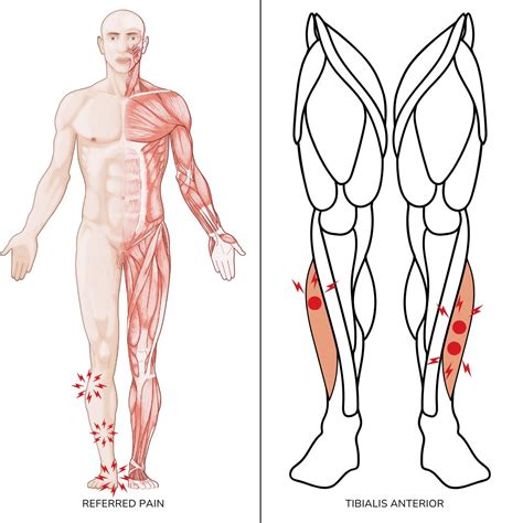 💥 Tibialis Anterior Trigger Points Nat Global Campus 💥 Tibialis Anterior Trigger Points Nat Global Campus
