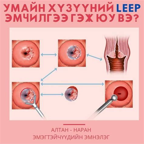 Алтан Наран эмэгтэйчүүдийн эмнэлэг УМАЙН ХҮЗҮҮНИЙ Leep ЭМЧИЛГЭЭ ГЭЖ ЮУ ВЭ ️ Leep эмчилгээ