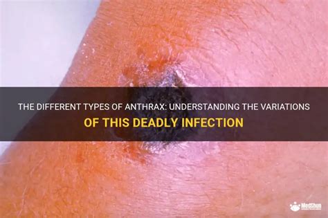 The Different Types Of Anthrax Understanding The Variations Of This Deadly Infection Medshun