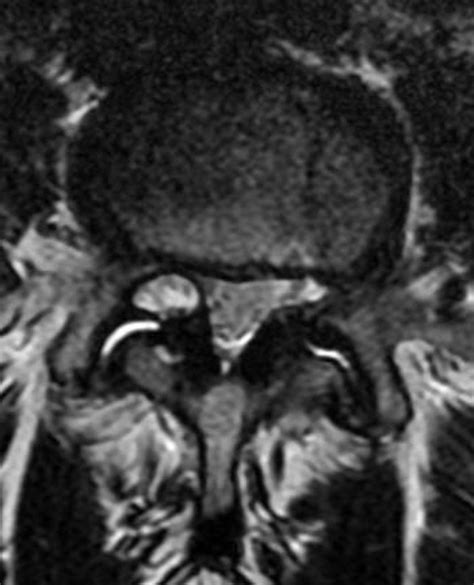 Cyst Back Spine At Fawn Adams Blog
